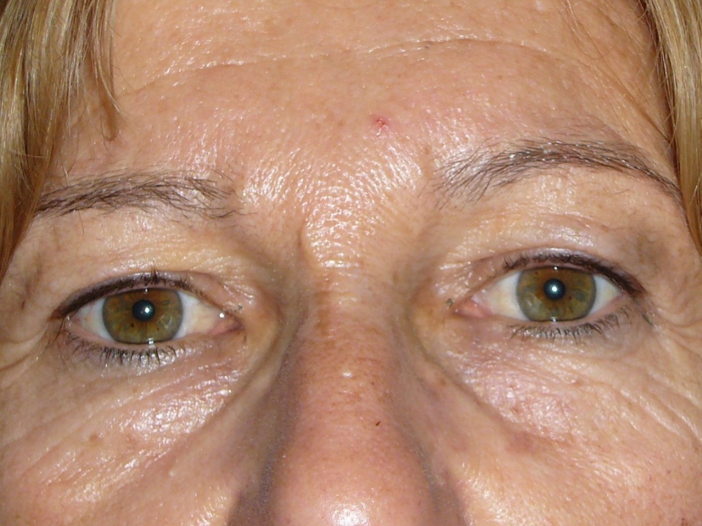 Dermatochalasis | Provence Vision